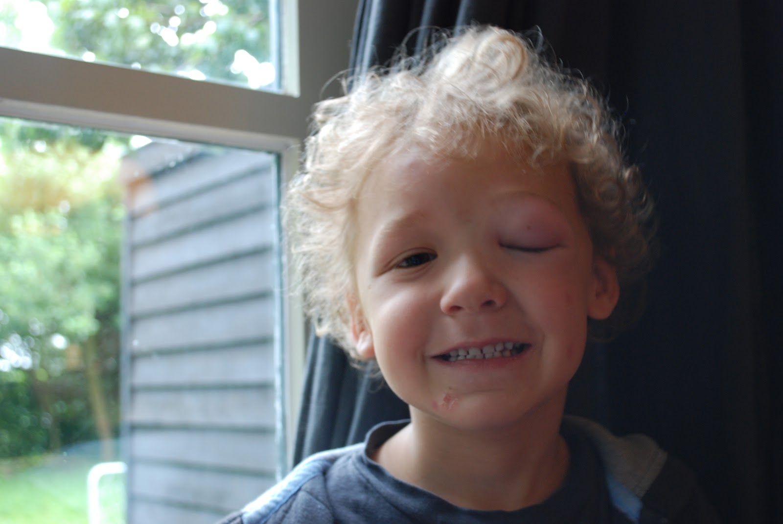 loonybin: Skeeter Syndrome Strikes Again