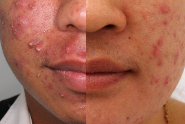 Cara Mengatasi Jerawat Yang Meradang | Obat Jantung Bengkak Tradisional