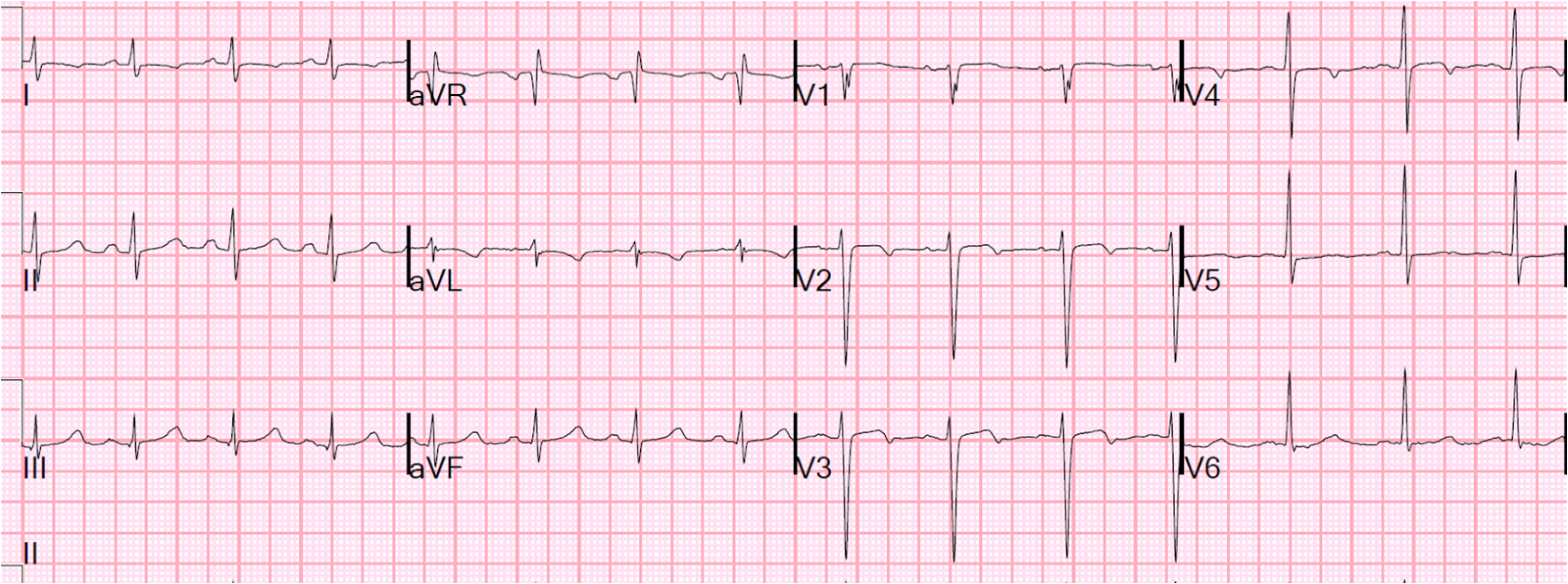 Dr. Smith's ECG Blog: Wellens' waves are NOT equivalent to Wellens ...