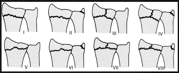 11:50: Clasificación de Frykman para fracturas del extremo distal del radio