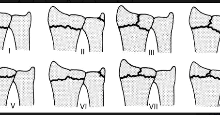 11:50: Clasificación de Frykman para fracturas del extremo distal del radio
