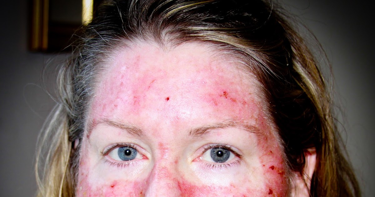 My Journey Through Topical Chemotherapy - Fluorouracil 5% Cream and ...