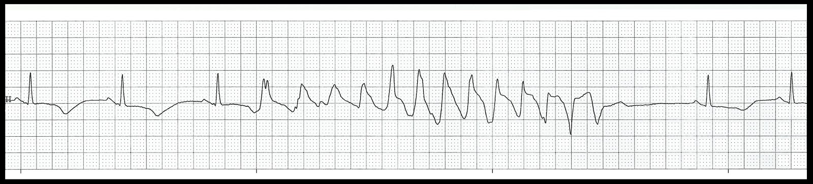 Practice EKG Rhythm Strips 171