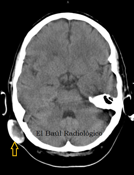 El Baúl Radiológico: OSTEOMAS CRANEALES. (Cranial Osteomas. CT Findings ...