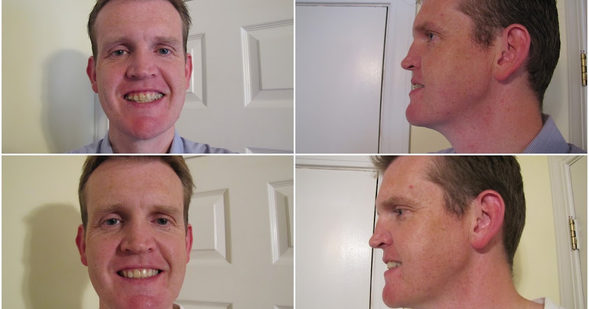 Double Jaw Operation - The Road to Recovery