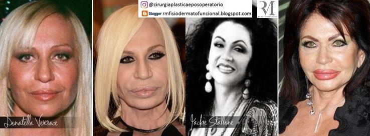 Fisioterapia em Pós Operatório de Cirurgias Plásticas: Transtorno ...