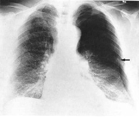 RADIOLOGI MAKASSAR: BELAJAR BACA FOTO THORAX