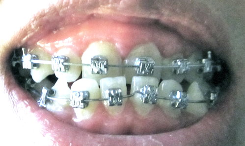 JUST ANOTHER METAL MOUTH