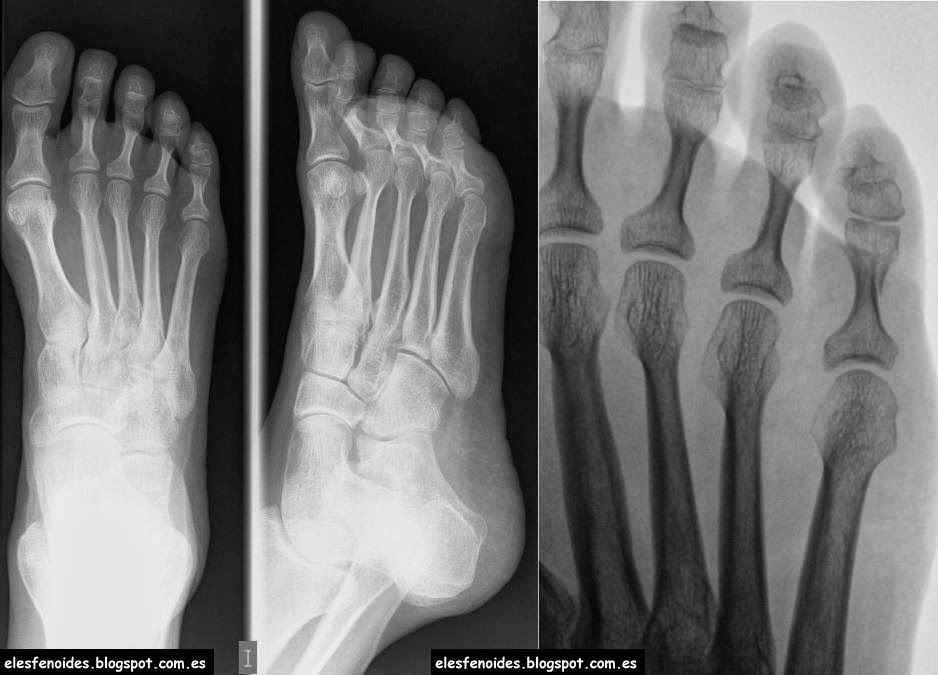 El esfenoides: Fractura de falange. 2 imágenes 1 caso.