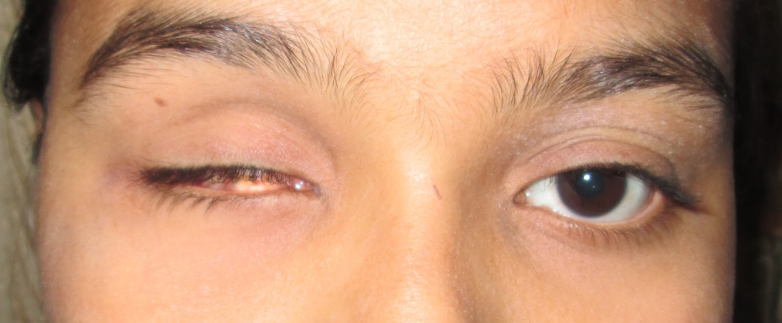 Ocularist in Kolkata: KARUNAMAYEE PROSTHETIC EYE CLINIC