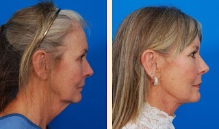 Chinese Acupressure Facelift Toning Exercises To Look Years Younger