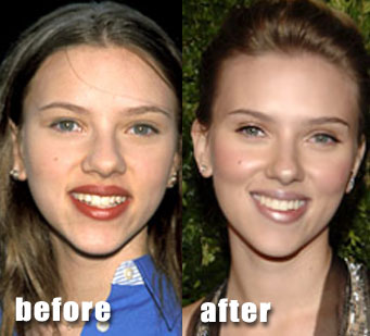 Celebrity Nose Jobs Before and After