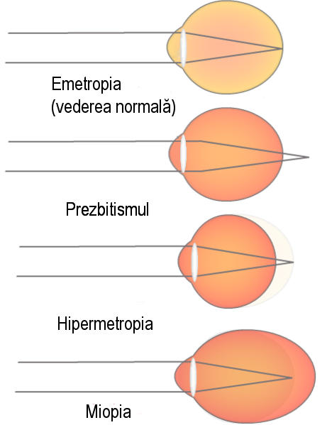 Stiutor.ro: Probleme oftalmologice