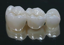 Carroll Dental Lab: Crystal Diamond Zirconia