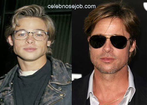 Brad Pitt Botox and Facial Fillers Plastic Surgery Before and After