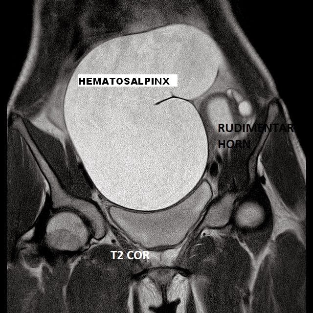 What Causes Hematosalpinx