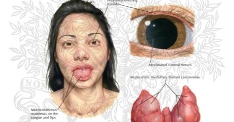 MULTIPLE ENDOCRINE NEOPLASIA TYPE 2 by Cèlia Güibas | MALALTIES GENÈTIQUES