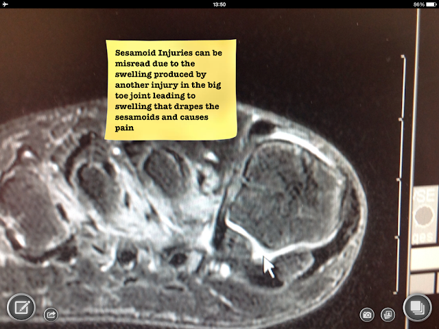 Foot and Ankle Problems By Dr. Richard Blake: Sesamoid Pain: Primary or ...
