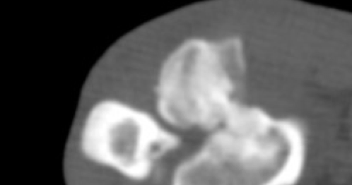 TGVET: IOHC Incompleta Ossificazione Condili Omerali