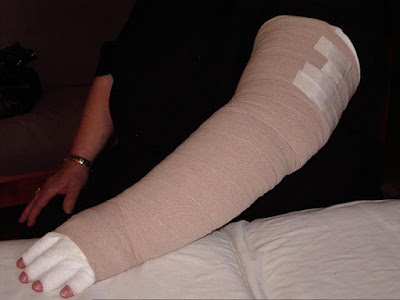 Lymphedema Management: Wrapping Your Arm to Manage Your Lymphedema
