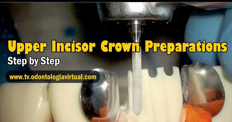UPPER INCISOR CROWN PREPARATIONS: Step by Step - Odonto-Tv