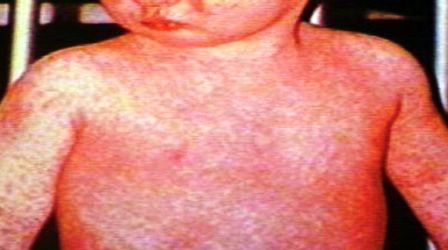 Pengertian dan Gejala Morbili (Campak)