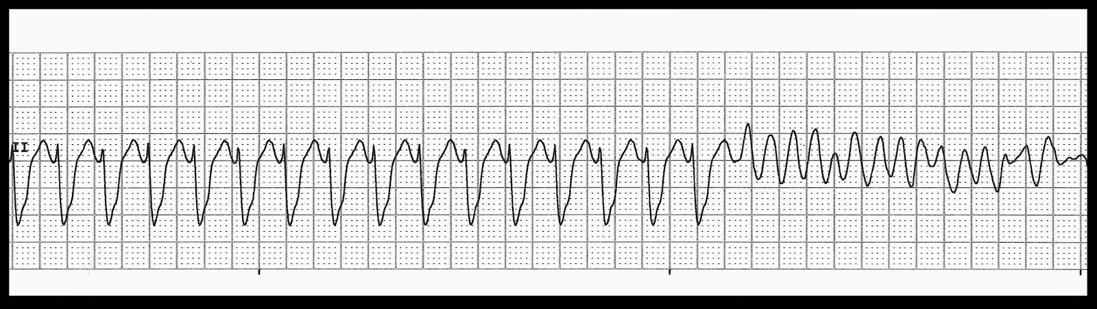 Various Ventricular Tachycardias