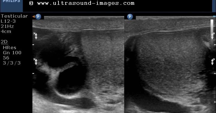cochinblogs: 3-D ultrasound of bilateral hydrocele