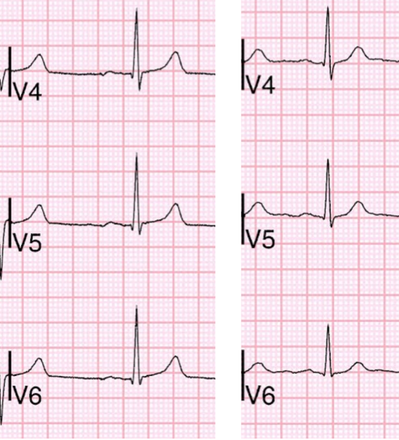 Dr. Smith's ECG Blog: Is this ECG diagnostic of coronary occlusion ...