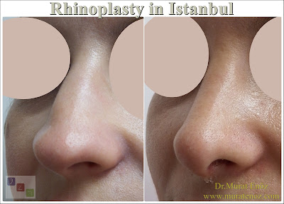 Health Zone Turkey: There Are Many Reasons to Choose Istanbul for Nasal ...
