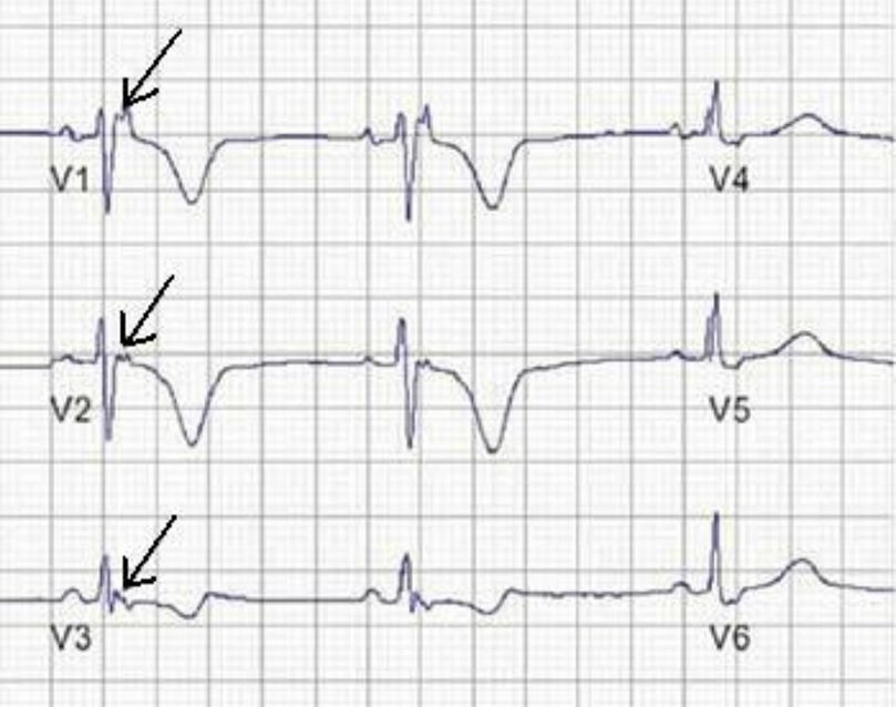 Learning Cardiology: How to identify right bundle branch block (RBBB ...