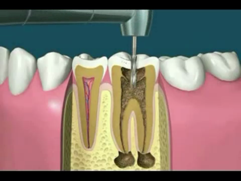 Dr. Nikhil's Microdentistry: Painless Root Canal Treatment