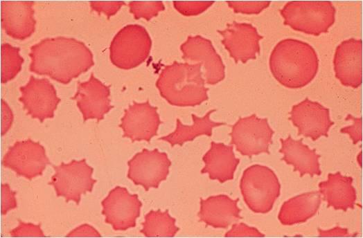 Células Sanguíneas: Anormalidades Morfológicas de los Eritrocitos