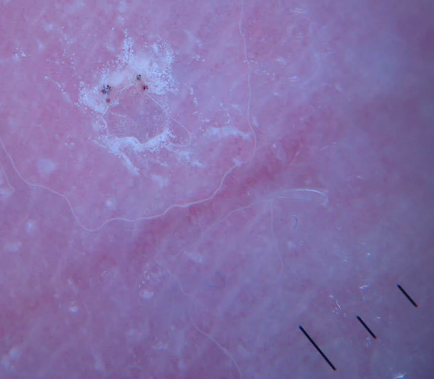 VIRTUAL GRAND ROUNDS IN DERMATOLOGY 2.0: Dermoscopy Rocks