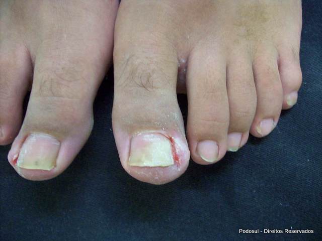 fotos podosul: Onicriptose