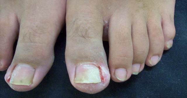 fotos podosul: Onicriptose