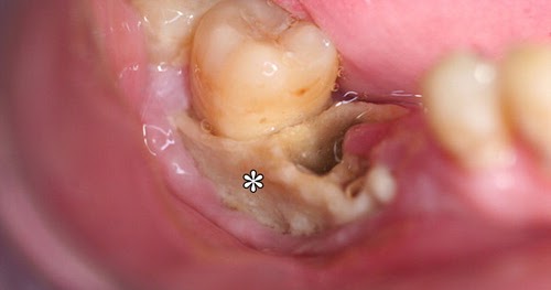 Happenings with Dom and Nan: A New Scare- Osteonecrosis of the Jaw