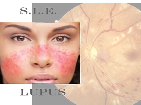 Tahukah Kamu Apa Itu Penyakit Lupus? ~ Dunia Sehat