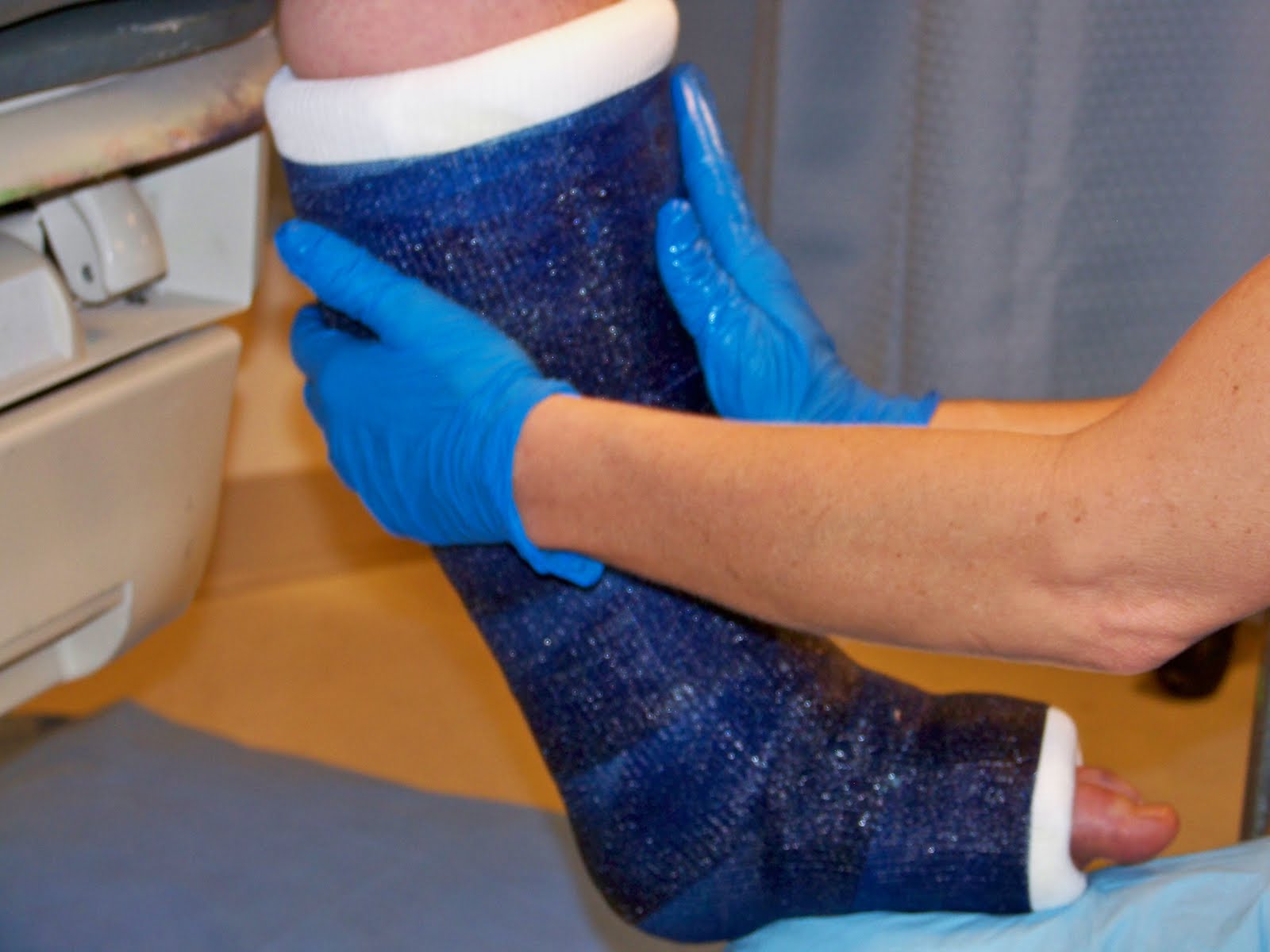 My posterior tibial tendon surgery journey: 6 week check up May 13, 2011