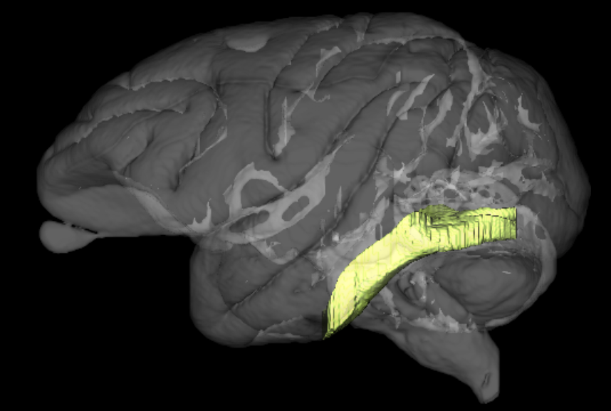 Atlas de neuroanatomía: FISURAS, SURCOS Y GIROS
