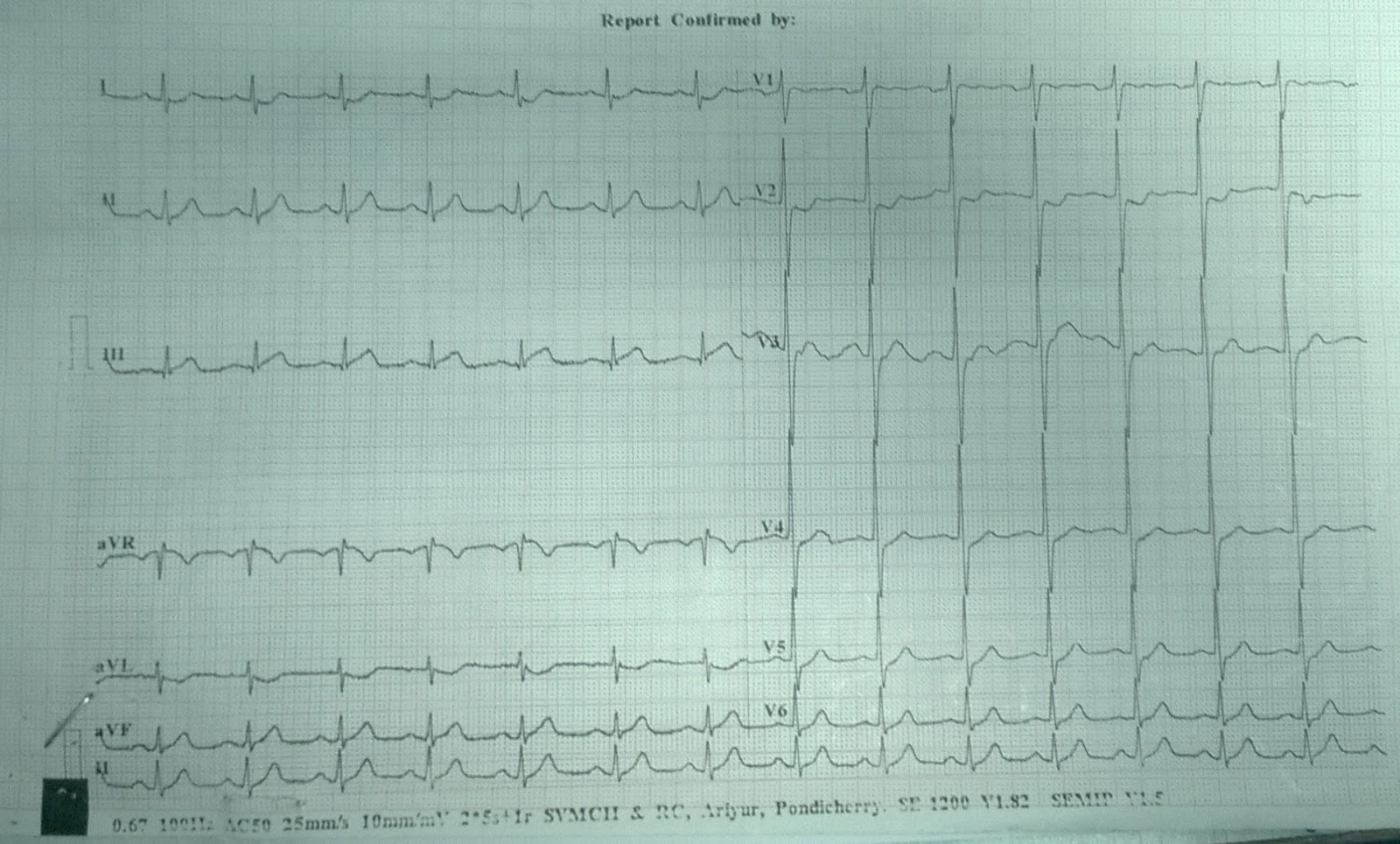 Cardiology window: Posterior wall myocardial infarction with inferior ...