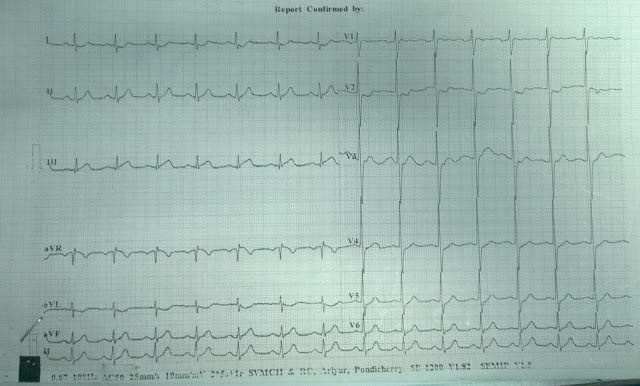 Cardiology window: Posterior wall myocardial infarction with inferior ...