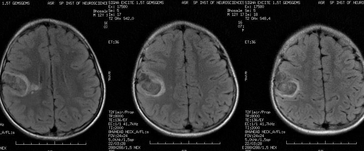 Neuroradiology Cases: Dysembryoplastic Neuro Epithelial Tumor (DNET)