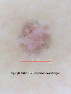 dermoscopy: Regression.