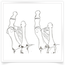 拇趾外翻原因, 拇趾外翻治療, 拇趾外翻手術 - 拇趾外翻專科診療中心: Non-bone-breaking soft tissue approach