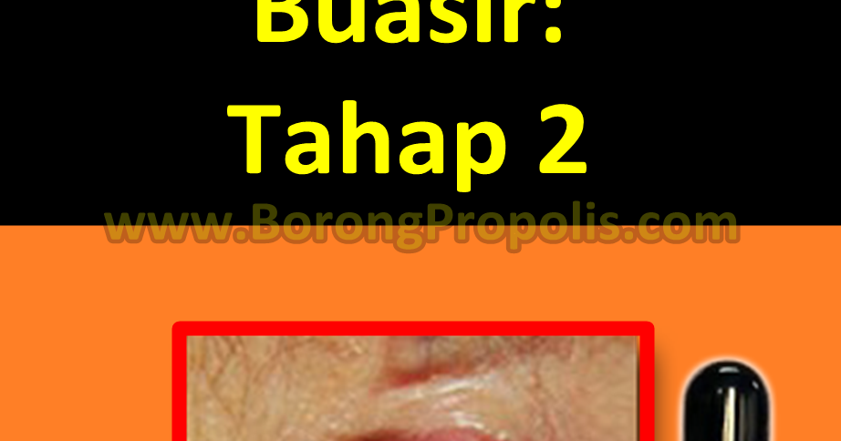 Nama Ubat Untuk Buasir - Residence l