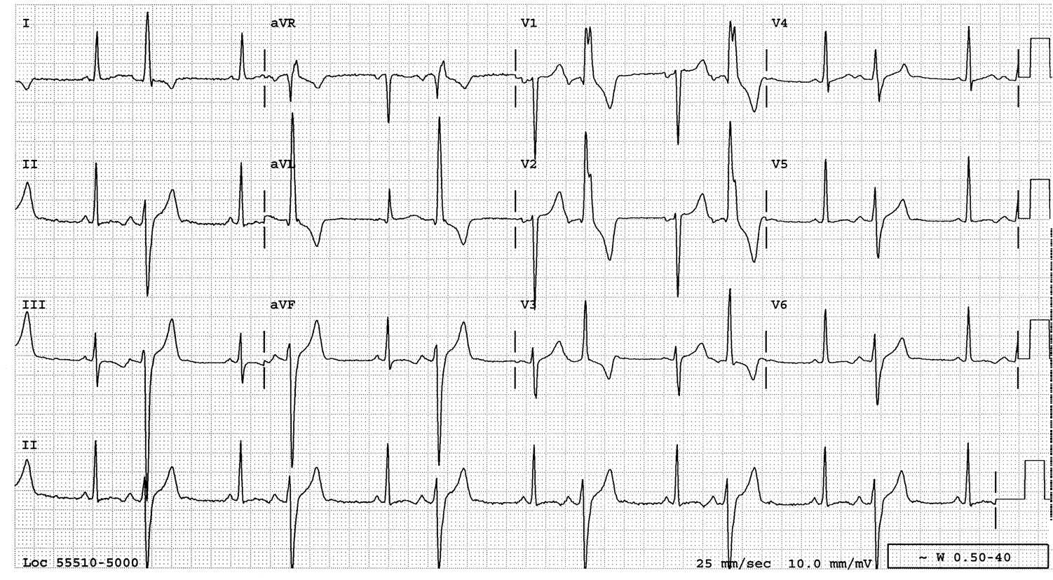 Dr. Smith's ECG Blog: PVC or Aberrant Conduction? (Another Guest Post ...