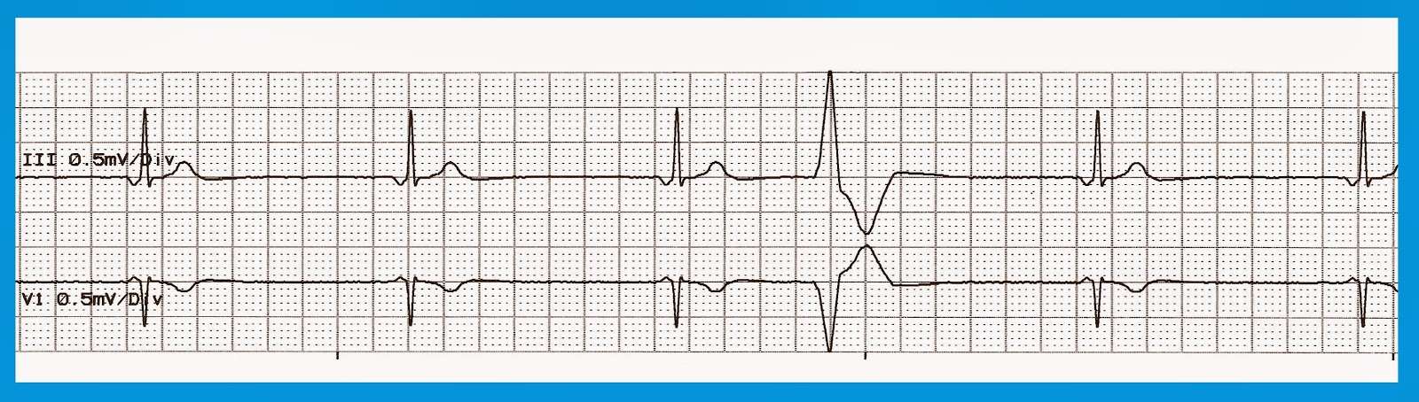 Float Nurse: Various Junctional Rhythms