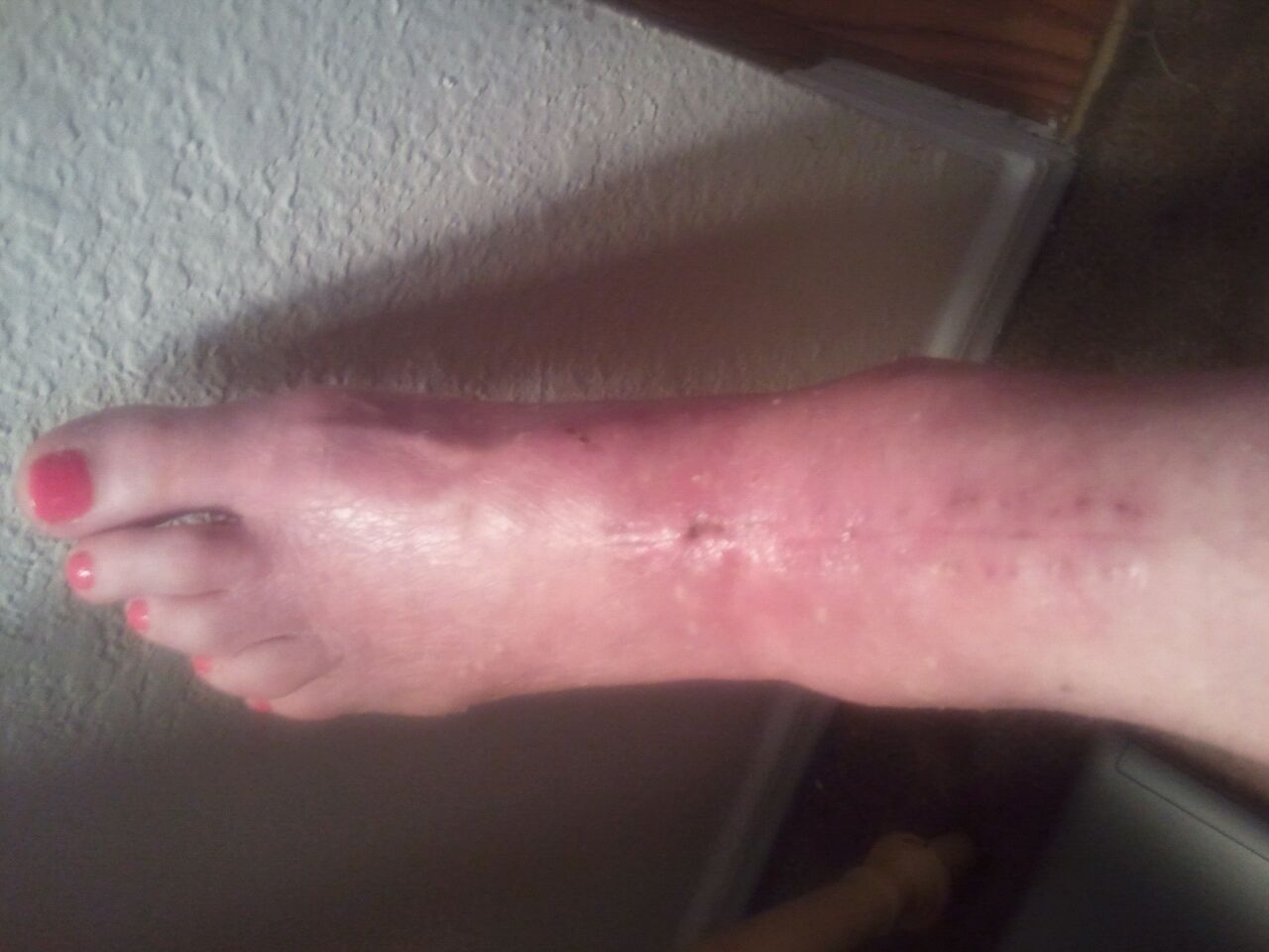 My Total Ankle Replacement: Post-op Photos - GRAPHIC!