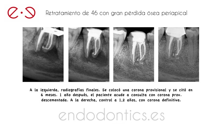 Endodoncia Microscópica Zaragoza: Reendodoncia en 46 con gran pérdida ...